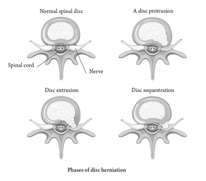 Why our intervertebral discs cannot slip! — Doctor Yogi