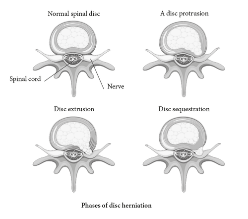 Why our intervertebral discs cannot slip! — Doctor Yogi