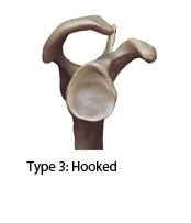 Dealing With Acromion Pain With The Best Exercises For Relief | Physiotherapists in Toronto ...