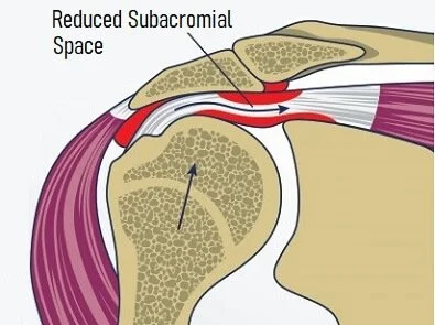 Dealing With Acromion Pain With The Best Exercises For Relief ...