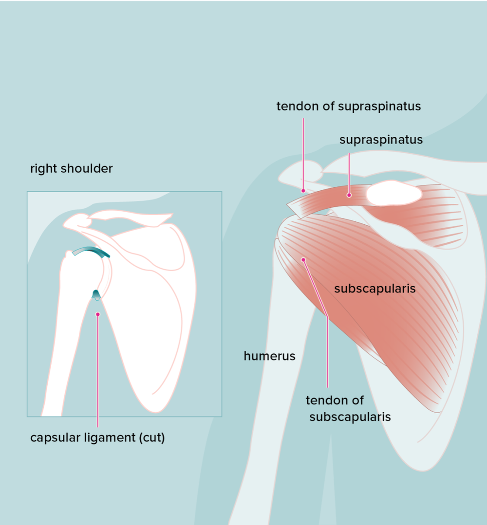 Dealing With Acromion Pain With The Best Exercises For Relief ...