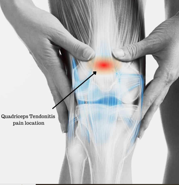 5 Best Exercises to Deal with Quadriceps Tendonitis | Physiotherapists ...