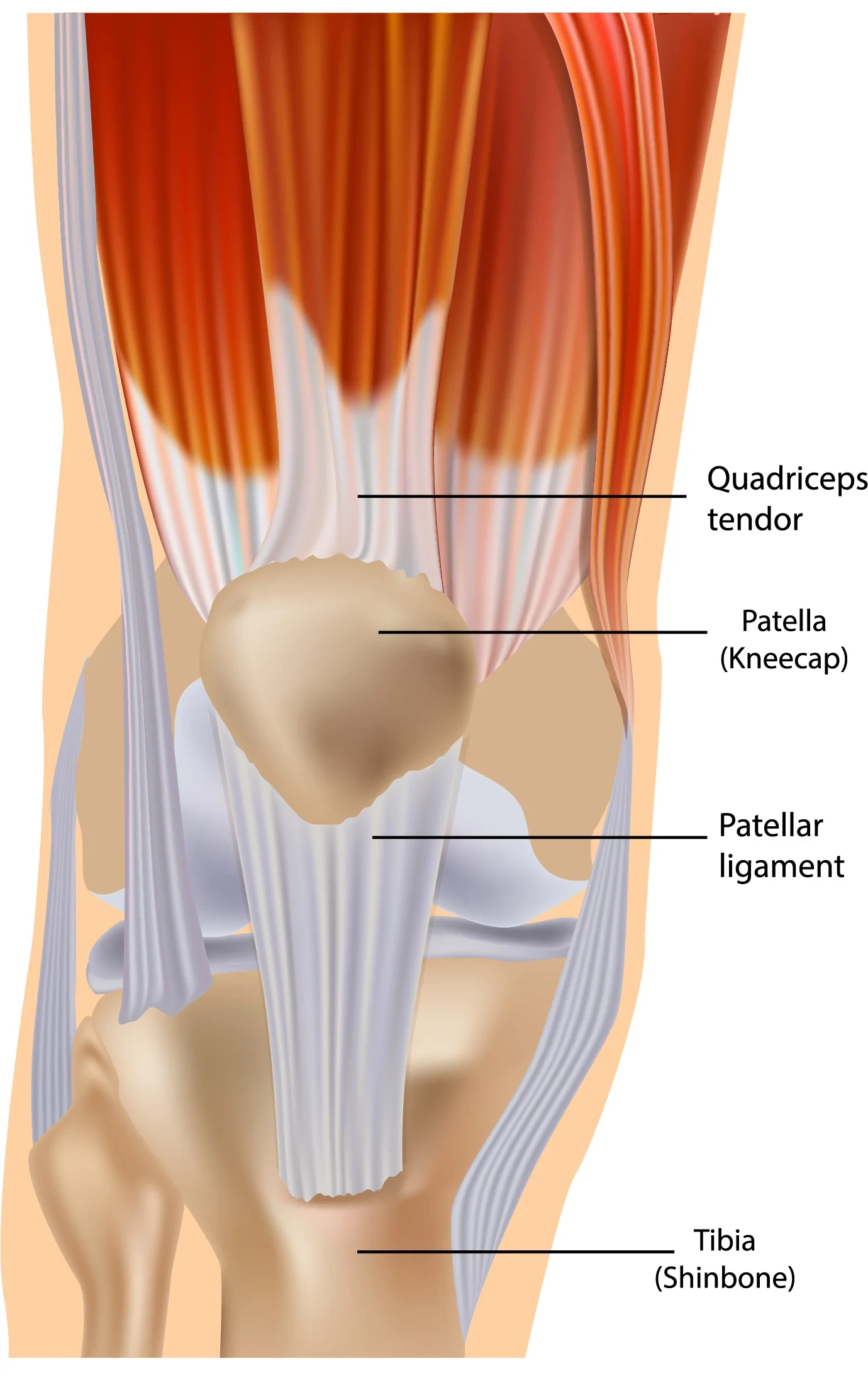 Patellar Tendon Tears — Adam B. Cohen, MD