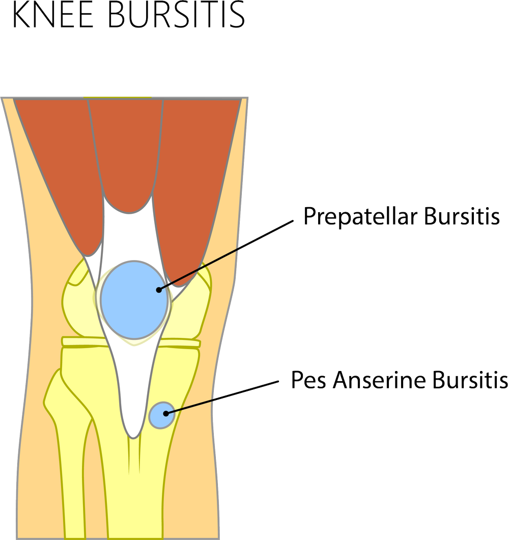 Knee Bursitis — Adam B. Cohen, MD