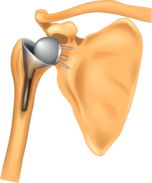 Reverse Total Shoulder Replacement — Adam B. Cohen, MD