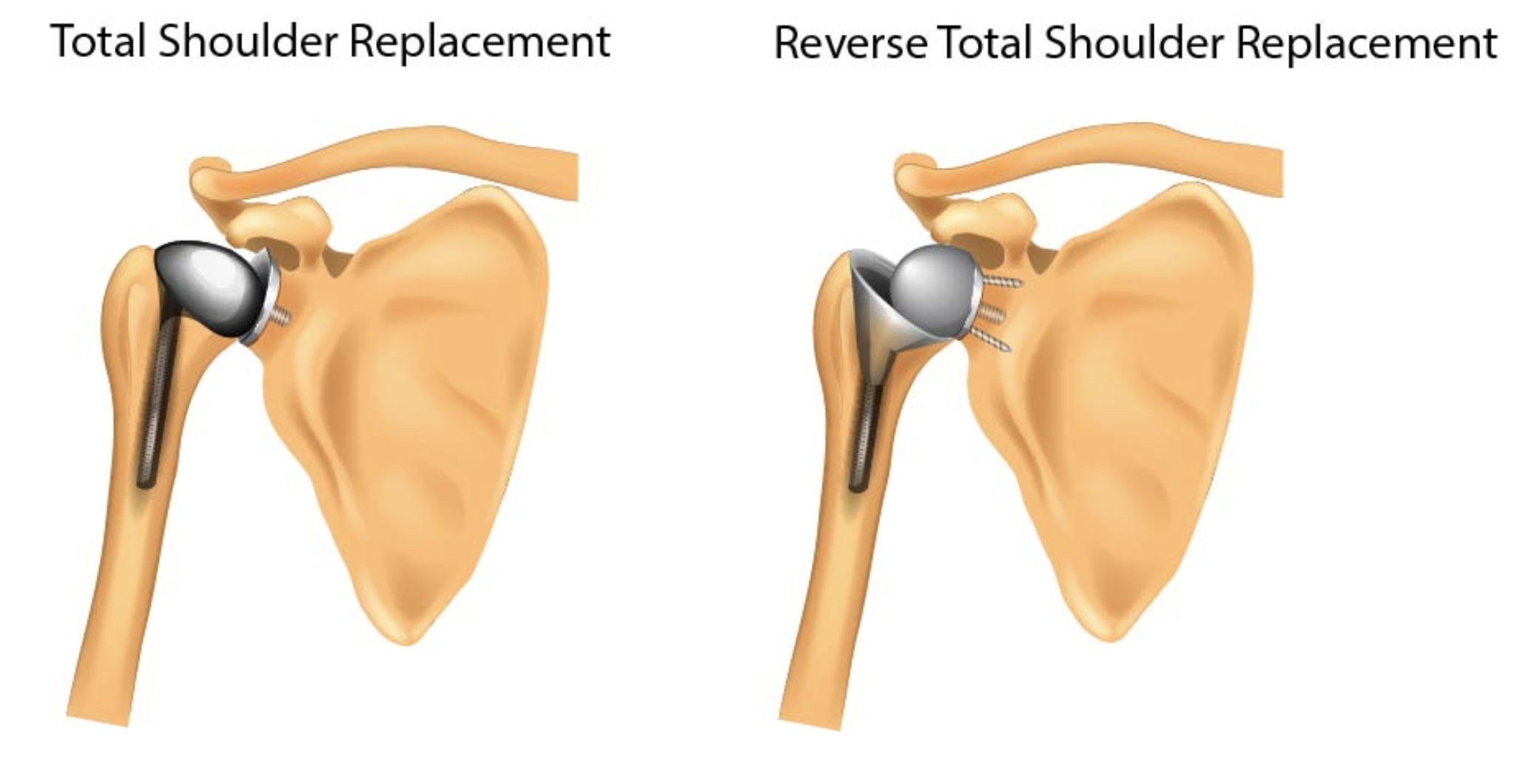 Reverse Total Shoulder Replacement Adam B Cohen MD Reverse Total Shoulder Replacement Adam B Cohen MD