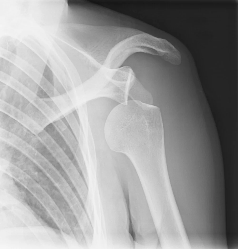 Bankart Repair — Adam B. Cohen, MD