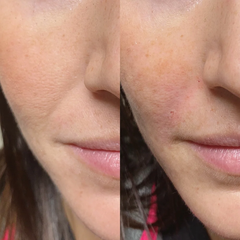 Facial Fillers, Hyaluronic Fillers | Denver City, Lubbock, TX & Hobbs ...