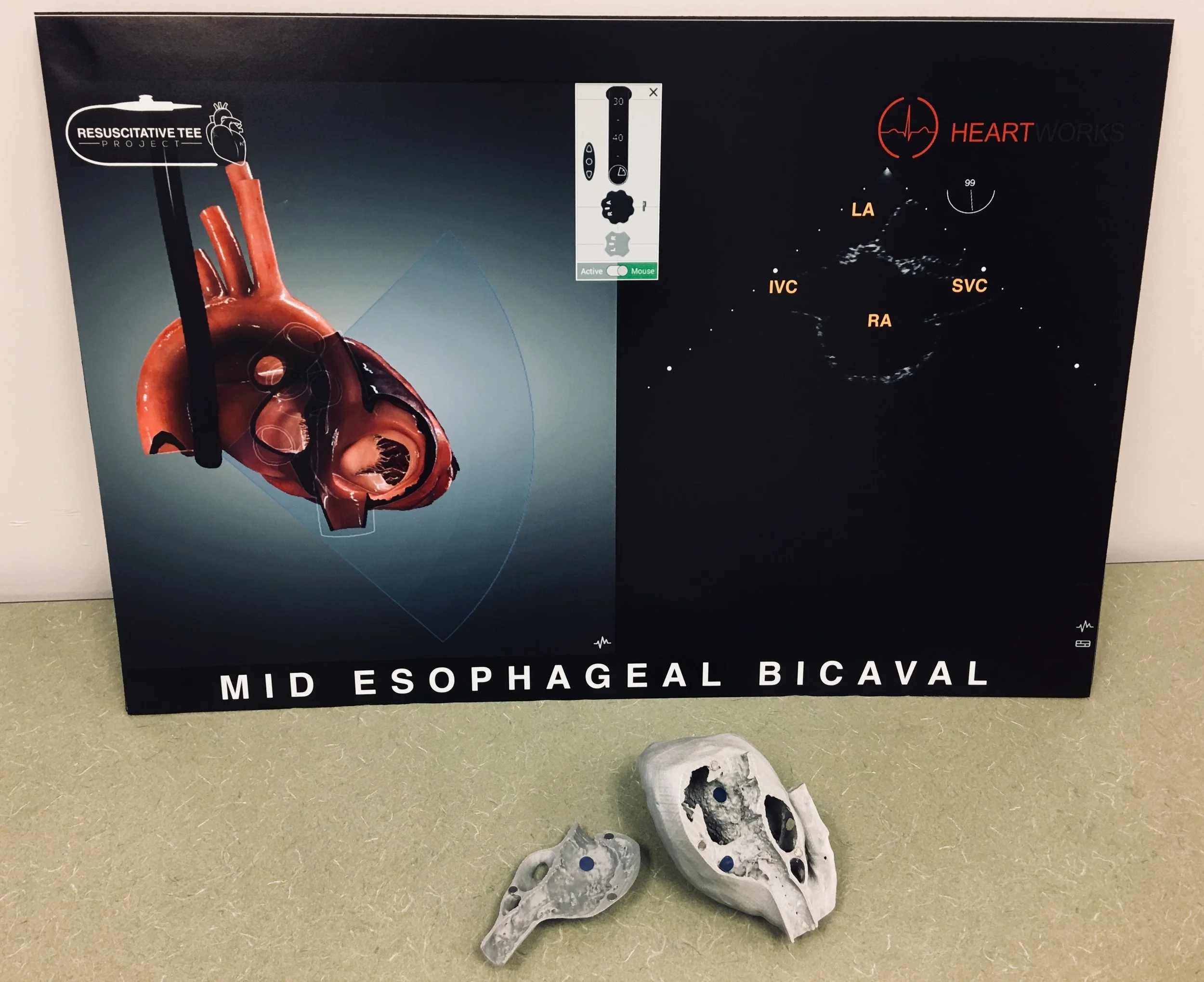 3D Printed Models — RESUSCITATIVE TEE PROJECT