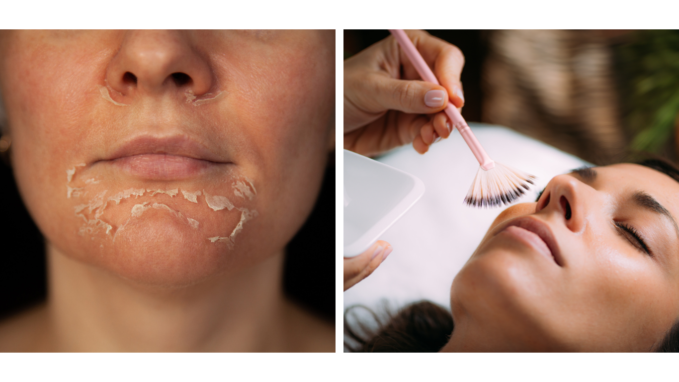 It's Chemical Peel Season. Find out why it's the perfect treatment for ...