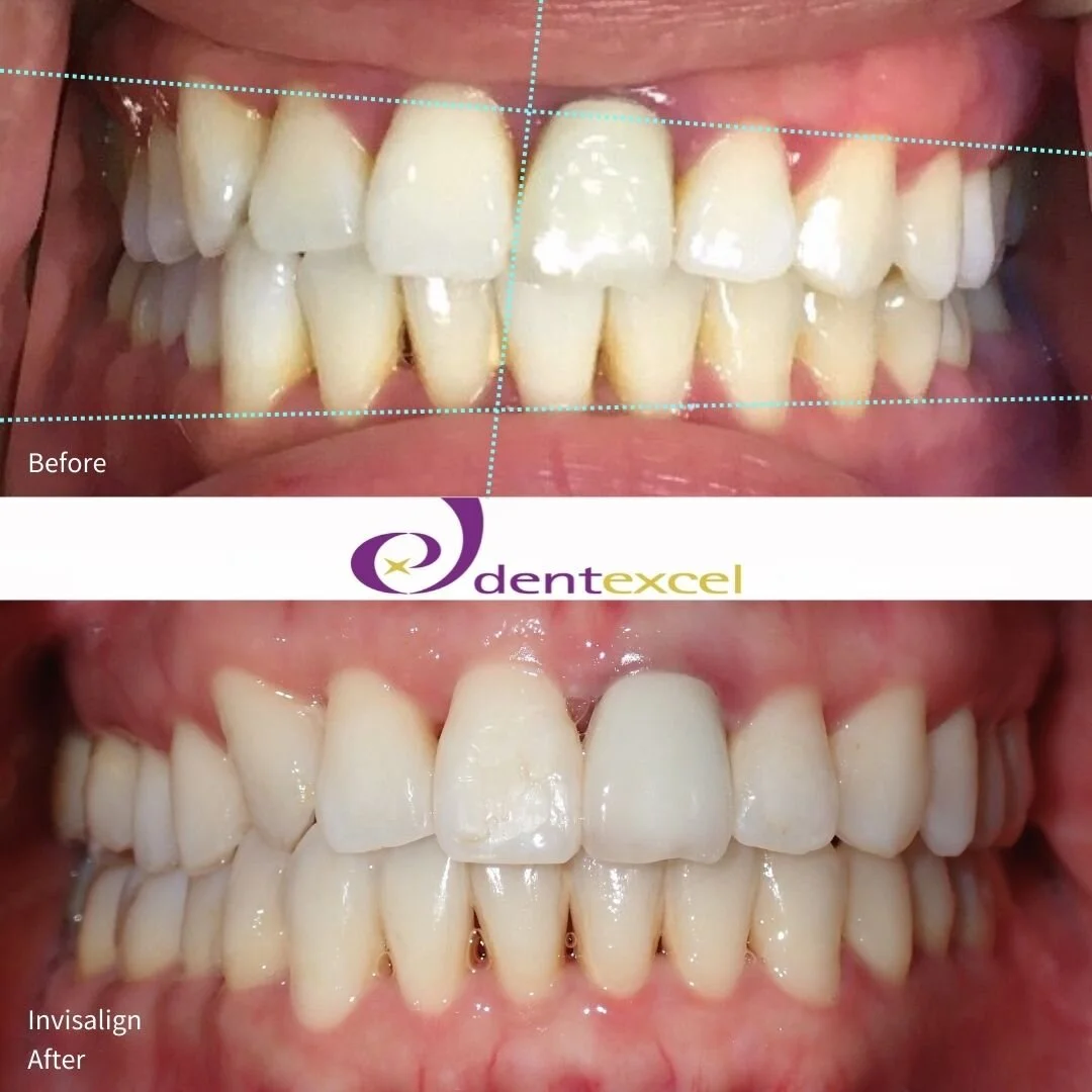 London UK Invisalign® l Dental Implants l 30 years' Experience l Private Dentist Harley Street