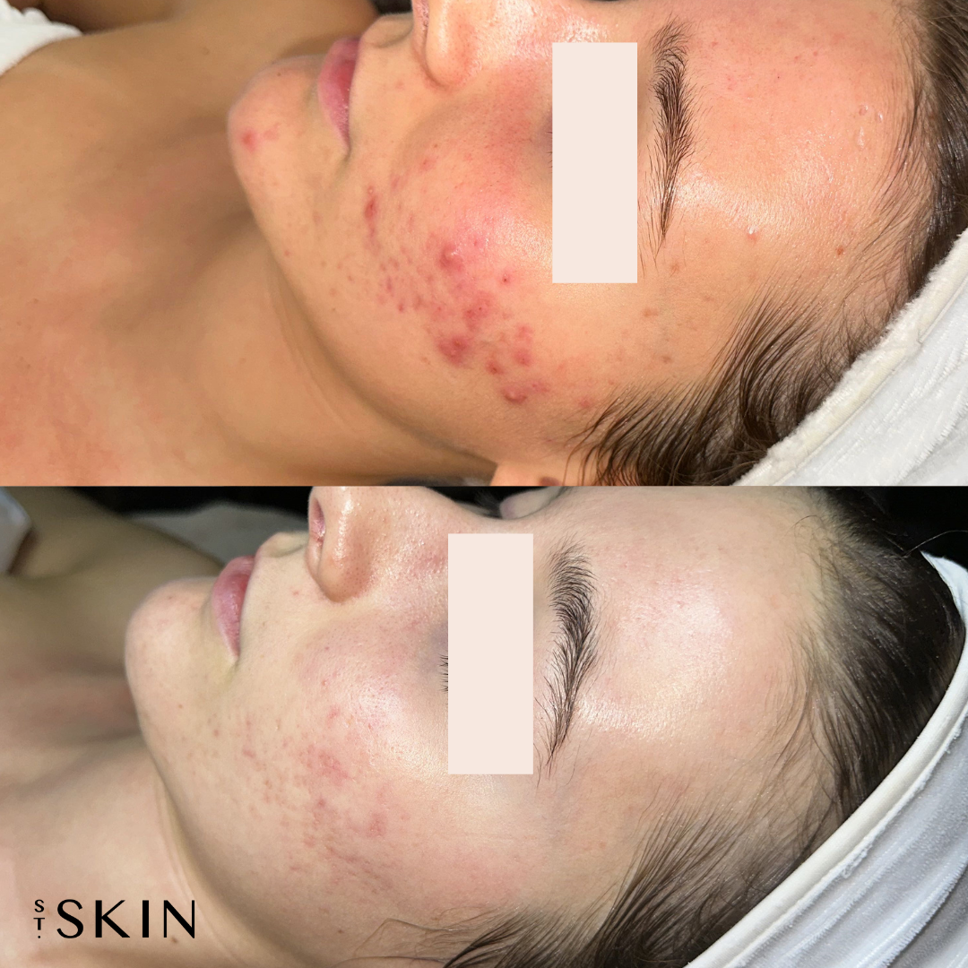 St. Skin Melbourne | Skin Care Specialists