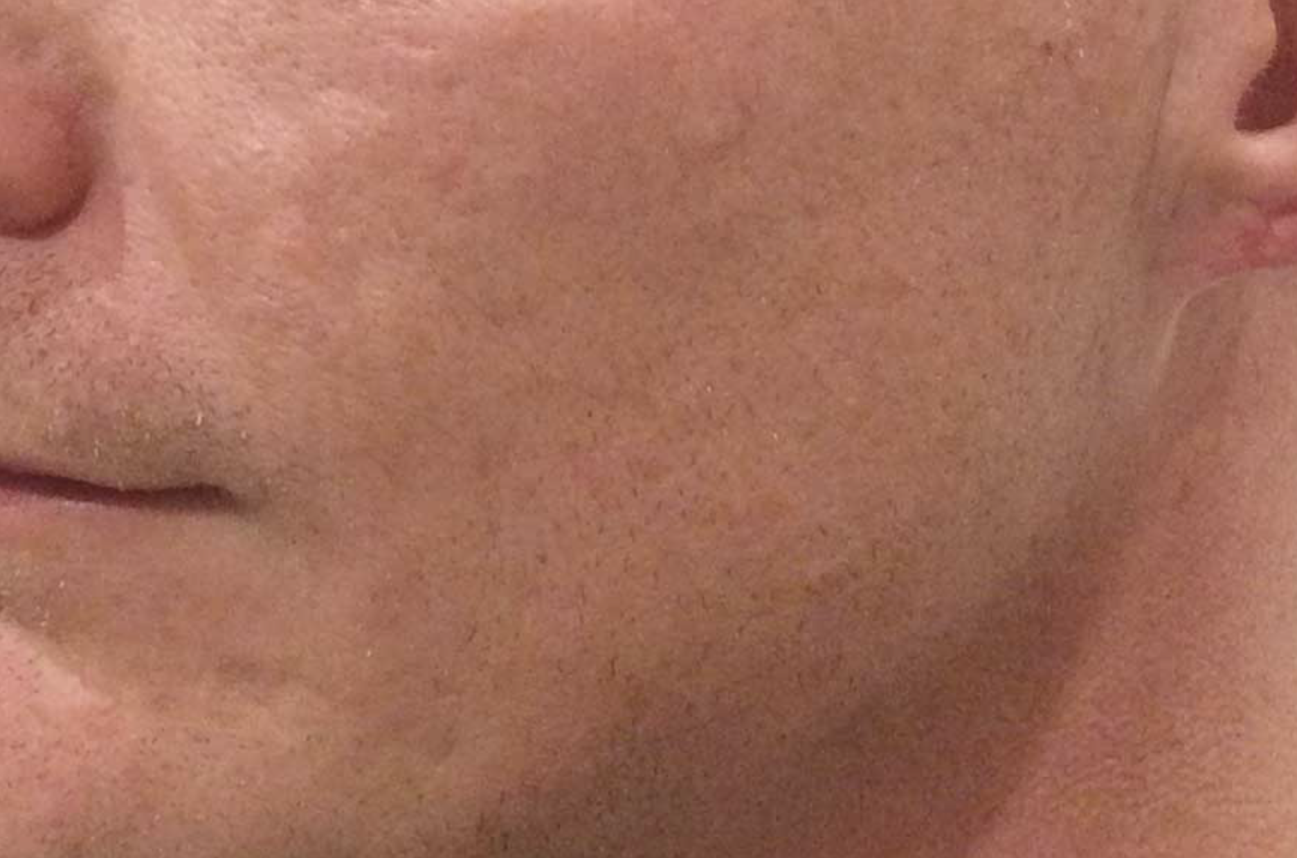 Acne Scar Treatments | Effective Solutions for Acne Scarring | Cedar ...