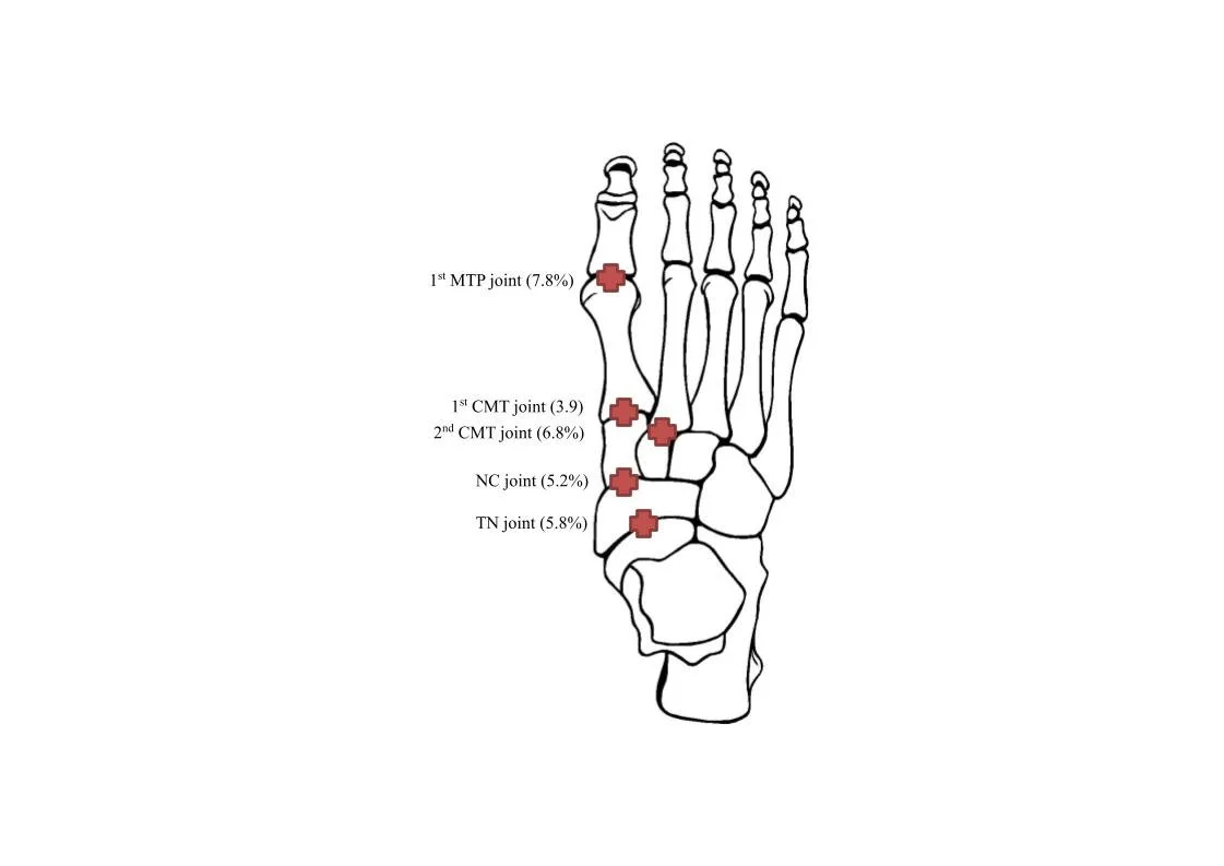 Foot Osteoarthritis - Manly Podiatry