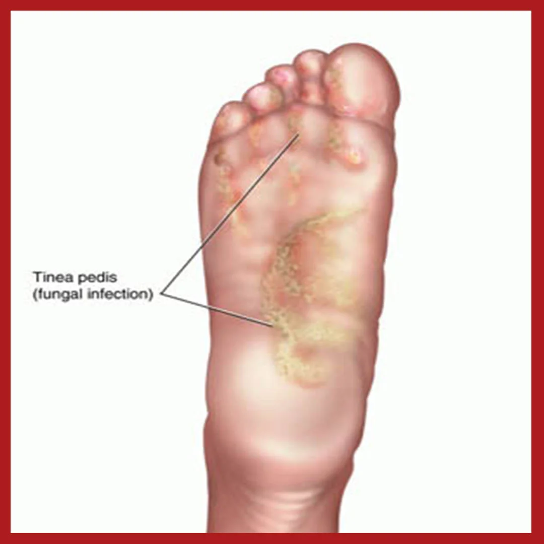 All 90 Images What Does Athlete s Foot Look Like Under A Microscope Superb All 90 Images What Does Athlete s Foot Look Like Under A Microscope Superb