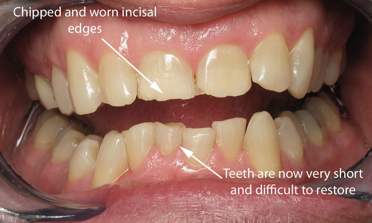 Teeth Grinding or Bruxism — Stephen Johansen Dentistry