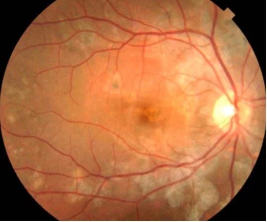 HLA-B27 Anterior Uveitis — Ophthalmology Review