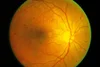 Classification Of Nonproliferative Diabetic Retinopathy — Ophthalmology ...