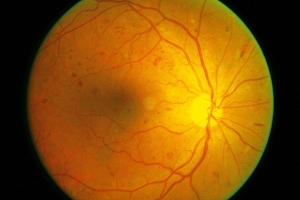 Classification Of Nonproliferative Diabetic Retinopathy — Ophthalmology ...
