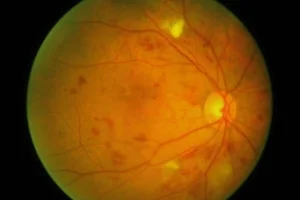 Classification Of Nonproliferative Diabetic Retinopathy — Ophthalmology ...