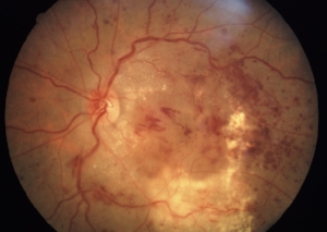 Classification Of Nonproliferative Diabetic Retinopathy — Ophthalmology ...