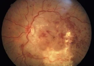 Classification Of Nonproliferative Diabetic Retinopathy — Ophthalmology ...