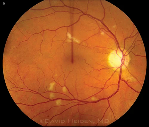 HIV And AIDS — Ophthalmology Review