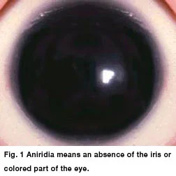 Aniridia — Ophthalmology Review