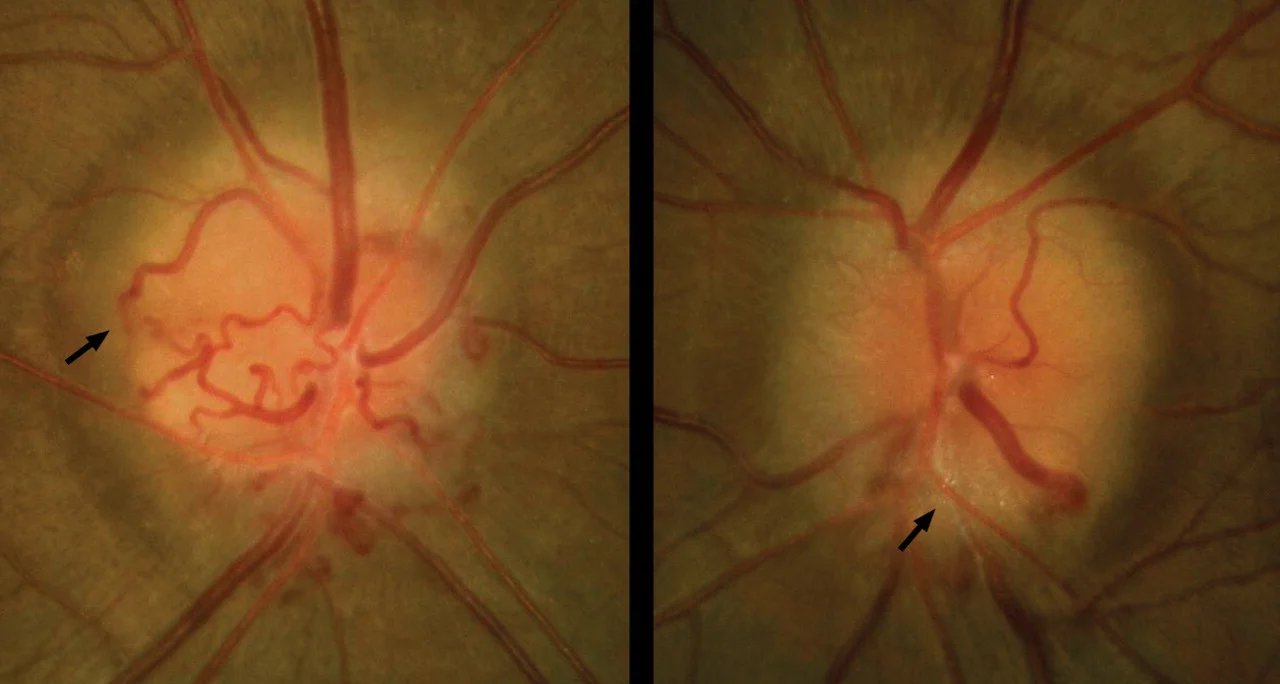 Papilledema — Ophthalmology Review