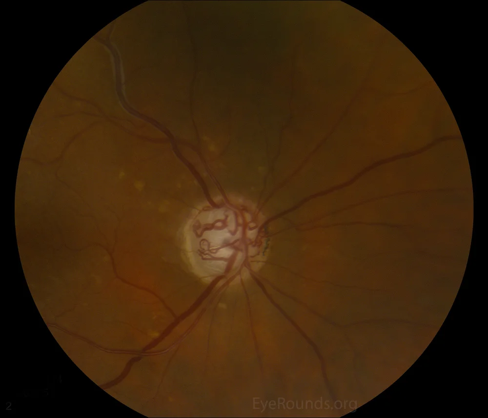 Optociliary Shunt Vessels — Ophthalmology Review