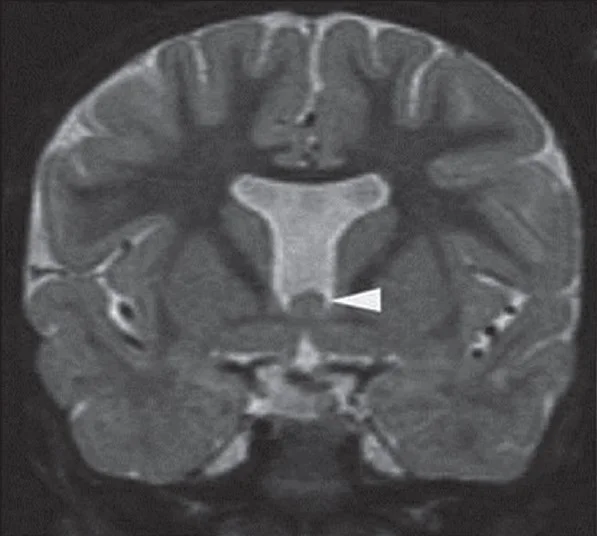 Congenital Optic Disc Anomalies — Ophthalmology Review