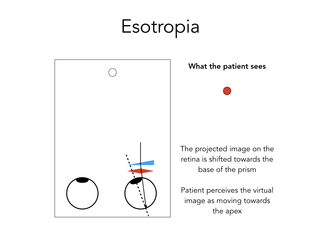 Introduction To Clinical Prisms — Ophthalmology Review