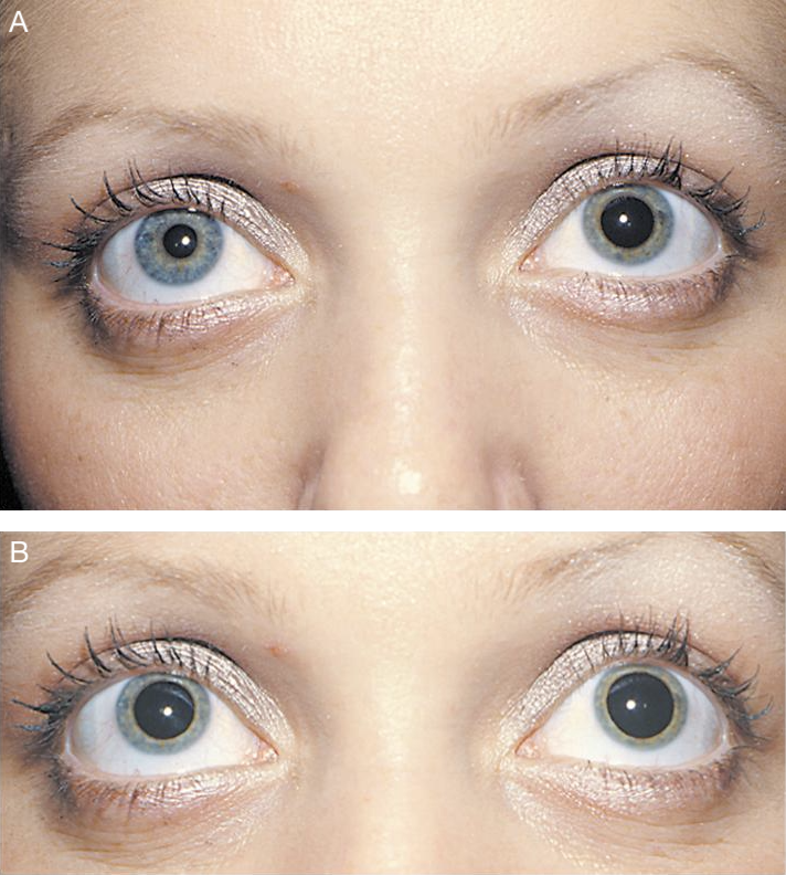 Horner Syndrome: Pharmacologic Diagnosis — Ophthalmology Review