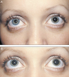 Horner Syndrome: Pharmacologic Diagnosis — Ophthalmology Review