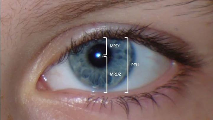 Eyelid Anatomy — Ophthalmology Review