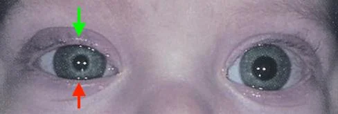 Eyelid Anatomy — Ophthalmology Review