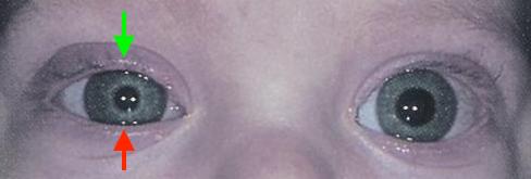 Eyelid Anatomy — Ophthalmology Review
