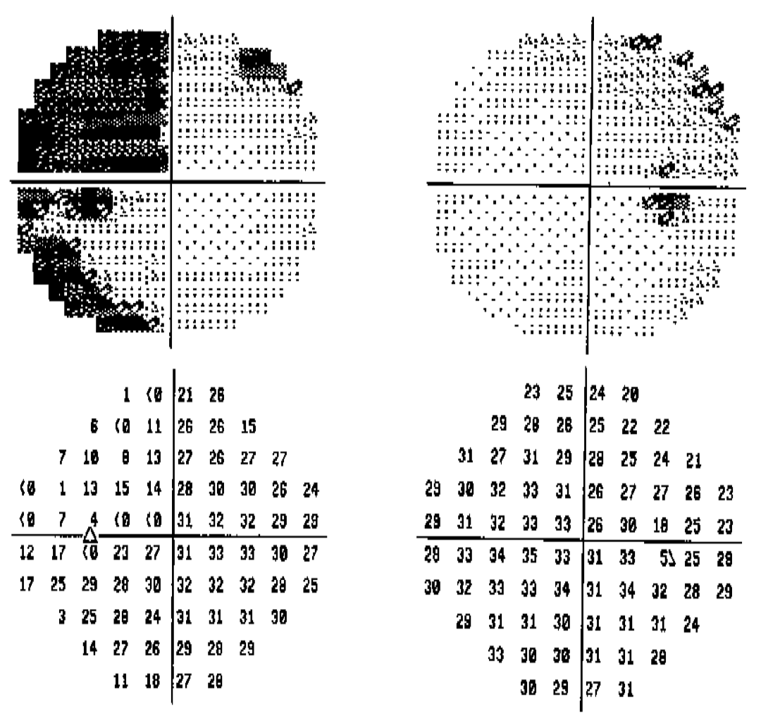 Visual Field Defects In Vascular Lesions vs. Tumors — Ophthalmology Review