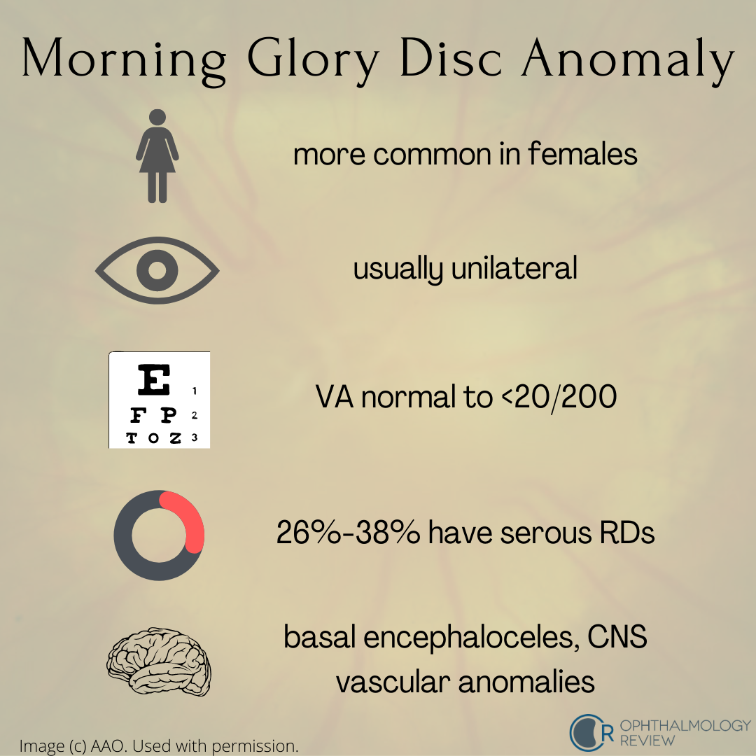 Morning Glory Disc Anomaly — Ophthalmology Review