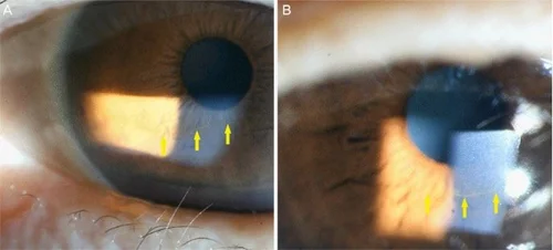Corneal Iron Lines — Ophthalmology Review