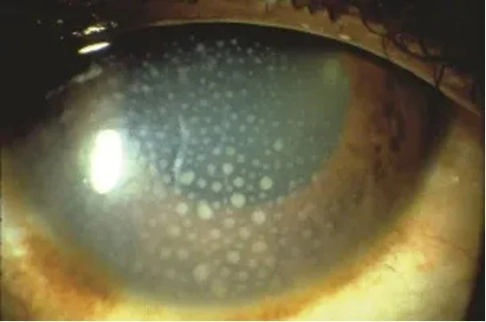 HLA-B27 Anterior Uveitis — Ophthalmology Review