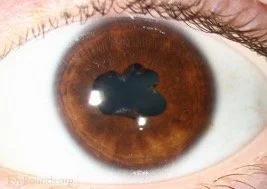 HLA-B27 Anterior Uveitis — Ophthalmology Review