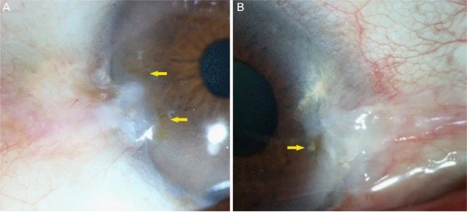 Corneal Iron Lines — Ophthalmology Review