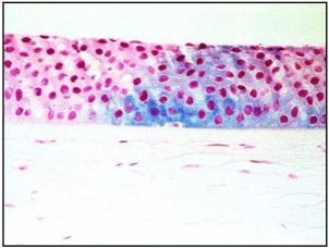 Corneal Iron Lines — Ophthalmology Review