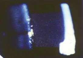 HLA-B27 Anterior Uveitis — Ophthalmology Review