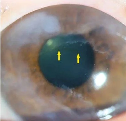 Corneal Iron Lines — Ophthalmology Review