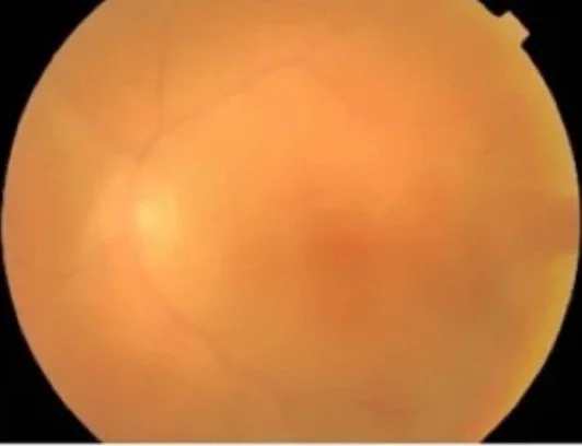 HLA-B27 Anterior Uveitis — Ophthalmology Review