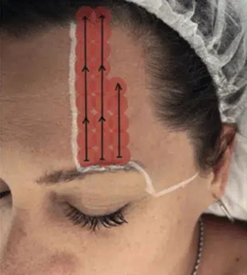 Fotona Vector Lift | The Aesthetic Studio Singapore Clinic & Surgery