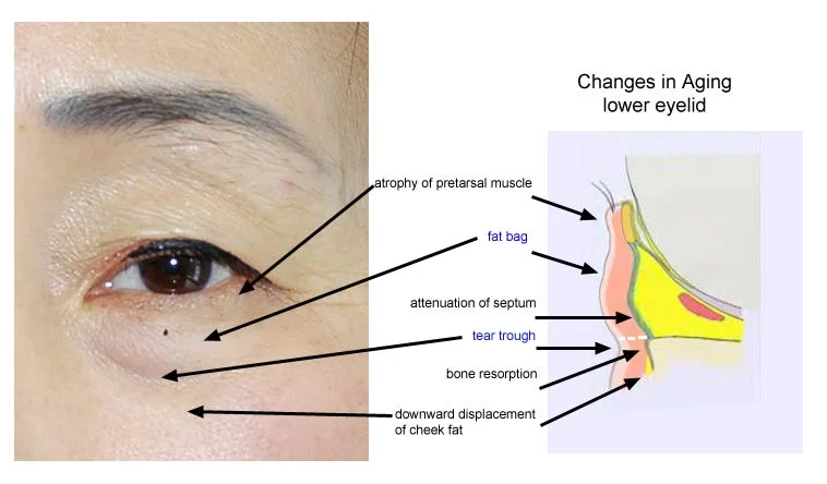 All About Eyebags The Aesthetic Studio Singapore Clinic Surgery
