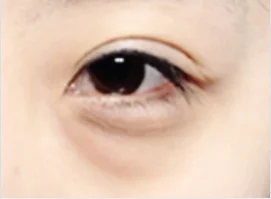 All About Eye-Bags — The Aesthetic Studio Singapore Clinic & Surgery